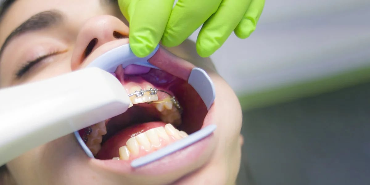 Brackets: Mejora tu salud dental y disfruta de una linda sonrisa